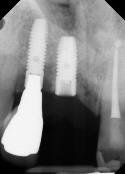 Another Example Of An Initial IMR Attempt Without Microscope Guidance ...