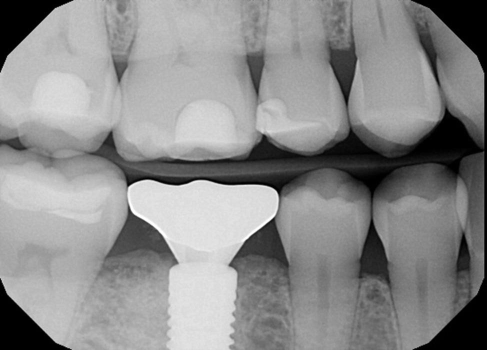 The Value of Microscope Visualization: Recovery of a Straumann RC ...
